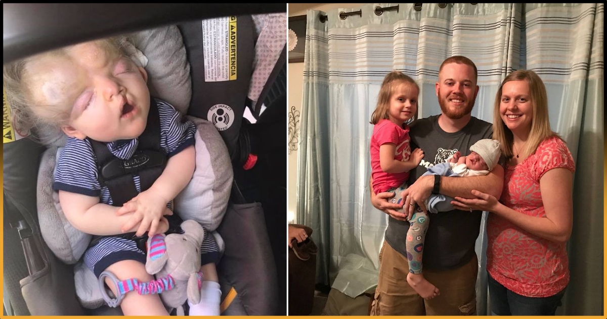 The Baby Who Was Born Without A Skull Celebrates His First Birthday