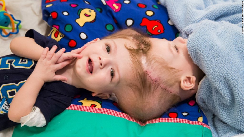 Twins Born With Conjoined Heads Finally Got Separated After 27 Hours Of ...