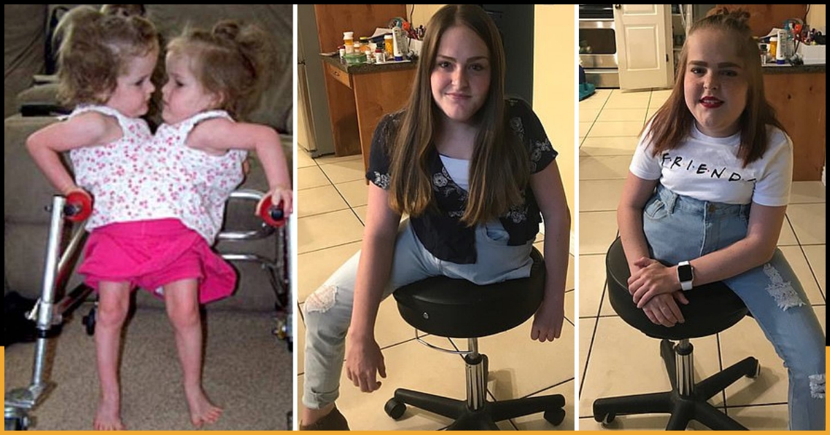Conjoined Twins Are Separated After Surgery That Leaves Them With One ...
