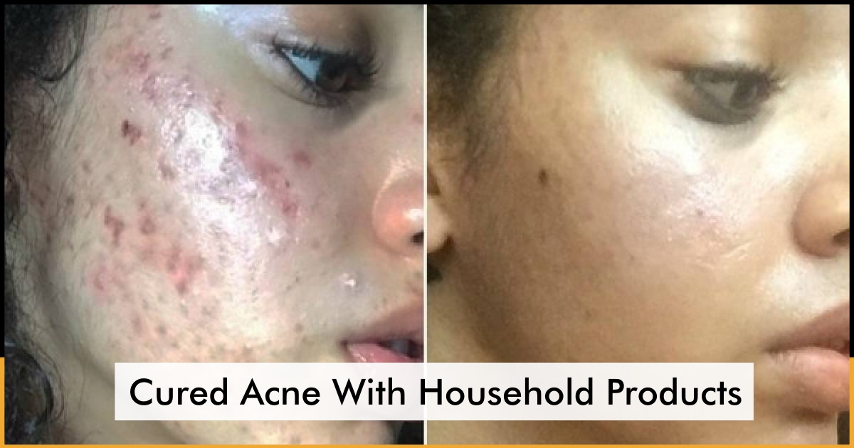 This Model Completely Cured Acne With The Help Of Household Products