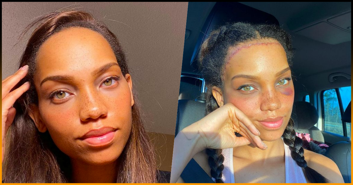 Model Spent $6,900 On Surgery To Reduce Forehead Size By 3cm